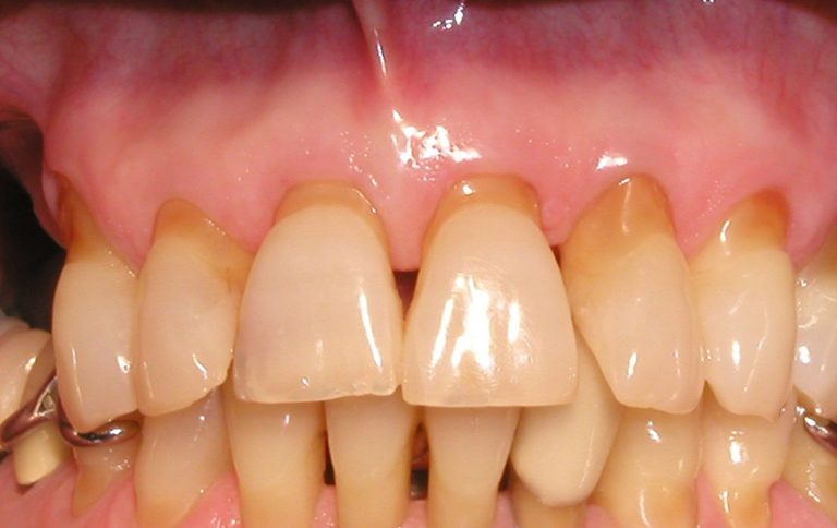 parodontite-esempio-1 - Studio Dentistico Perissinotto